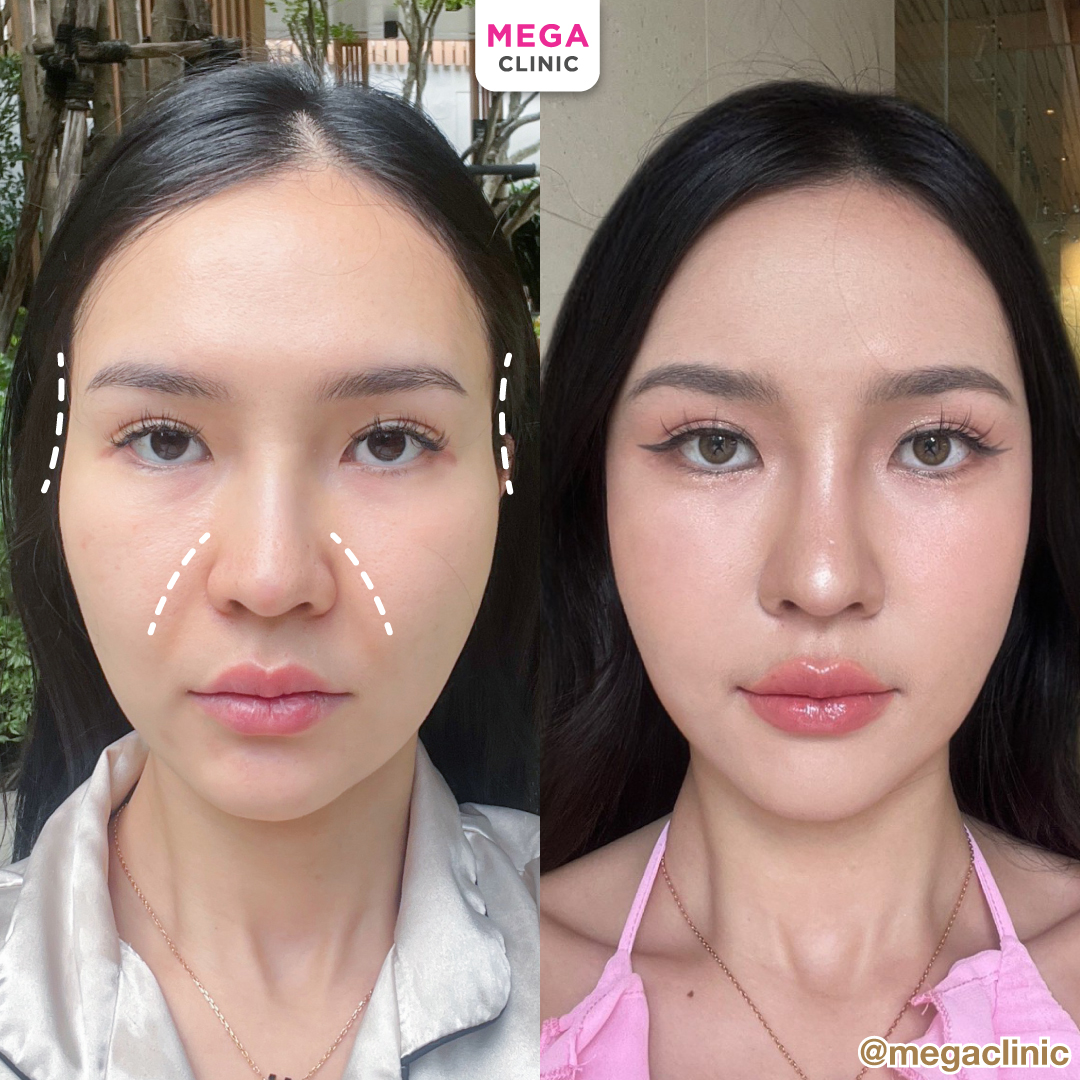 ฉีดฟิลเลอร์ แก้หน้าโทรมแค่ไหน? มาดู 5 สิ่งที่เปลี่ยนไป | MEGA CLINIC
