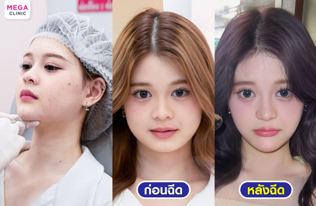 ฟิลเลอร์คาง แก้หน้ากลม ด้วยฟิลเลอร์ Neuramis | MEGA CLINIC