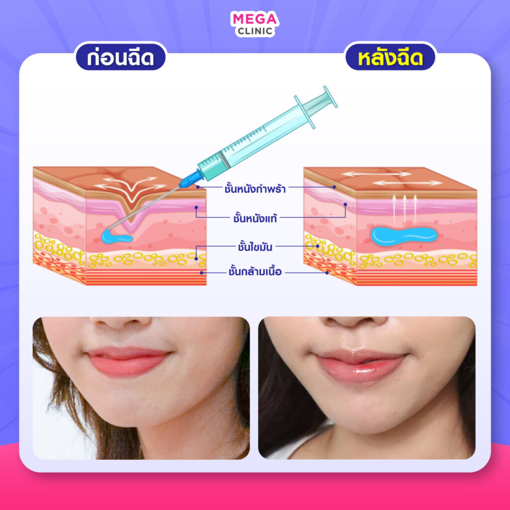 ฟิลเลอร์คาง แก้หน้ากลม ด้วยฟิลเลอร์ Neuramis | MEGA CLINIC