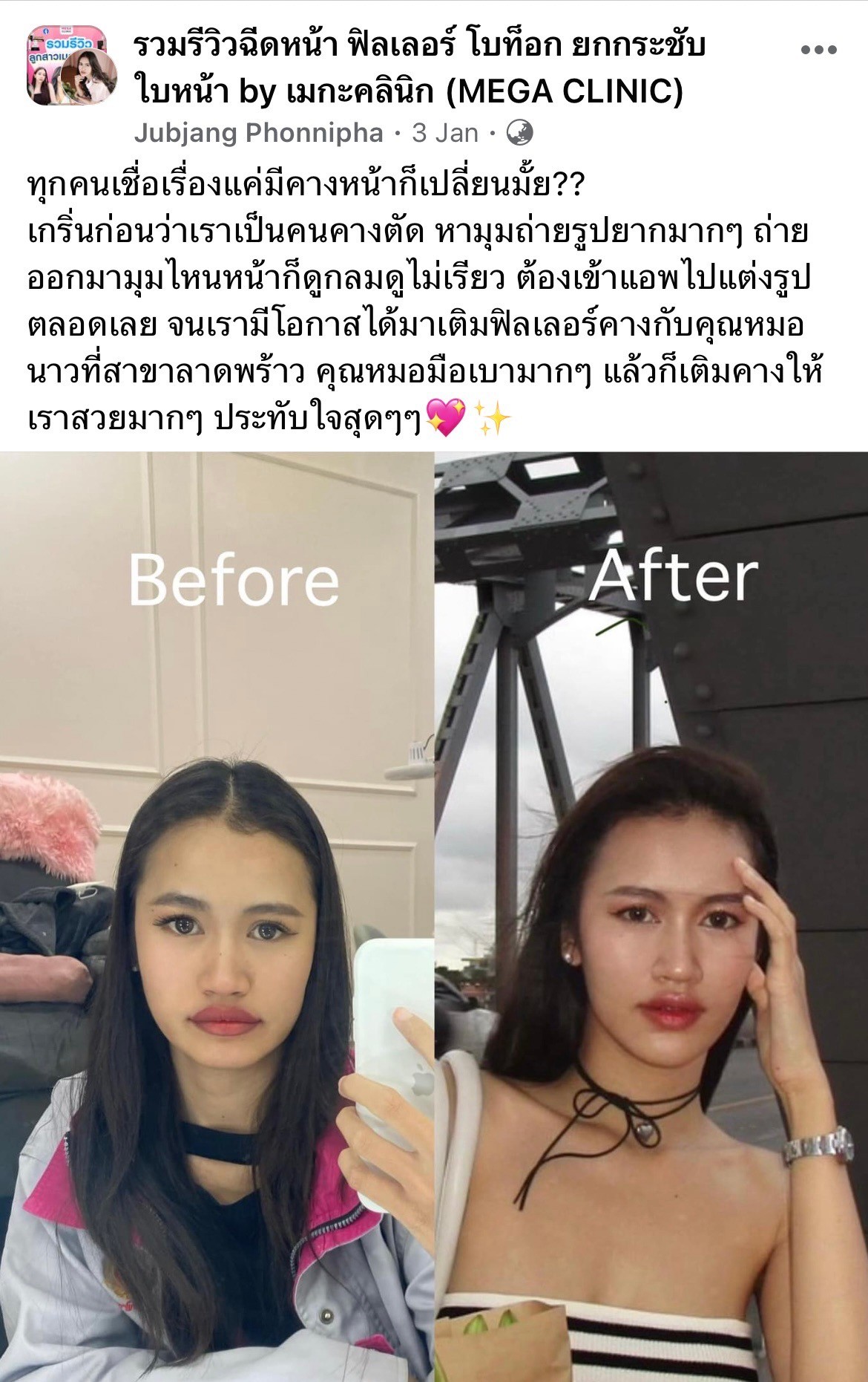 ฟิลเลอร์คาง แก้หน้ากลม ด้วยฟิลเลอร์ Neuramis | MEGA CLINIC