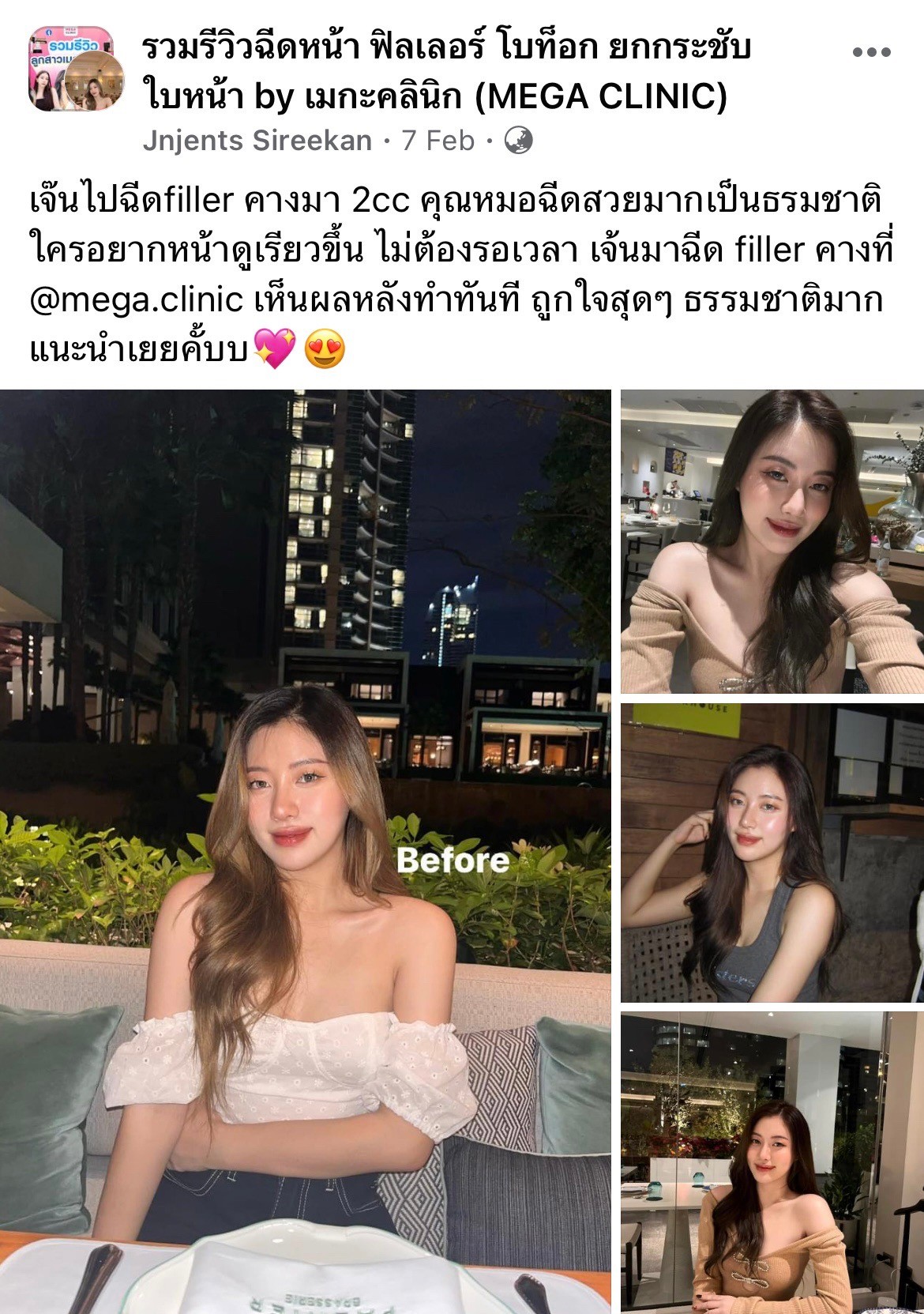 ฟิลเลอร์คาง แก้หน้ากลม ด้วยฟิลเลอร์ Neuramis | MEGA CLINIC