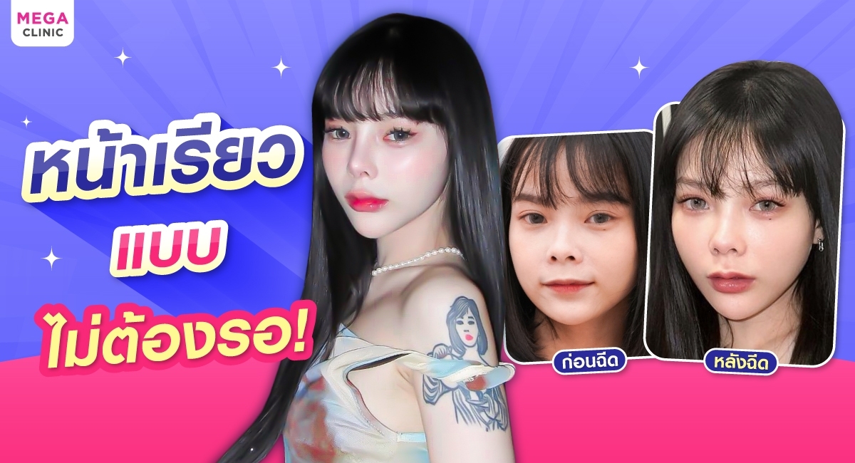 ฟิลเลอร์คาง แก้หน้ากลม ด้วยฟิลเลอร์ Neuramis | MEGA CLINIC