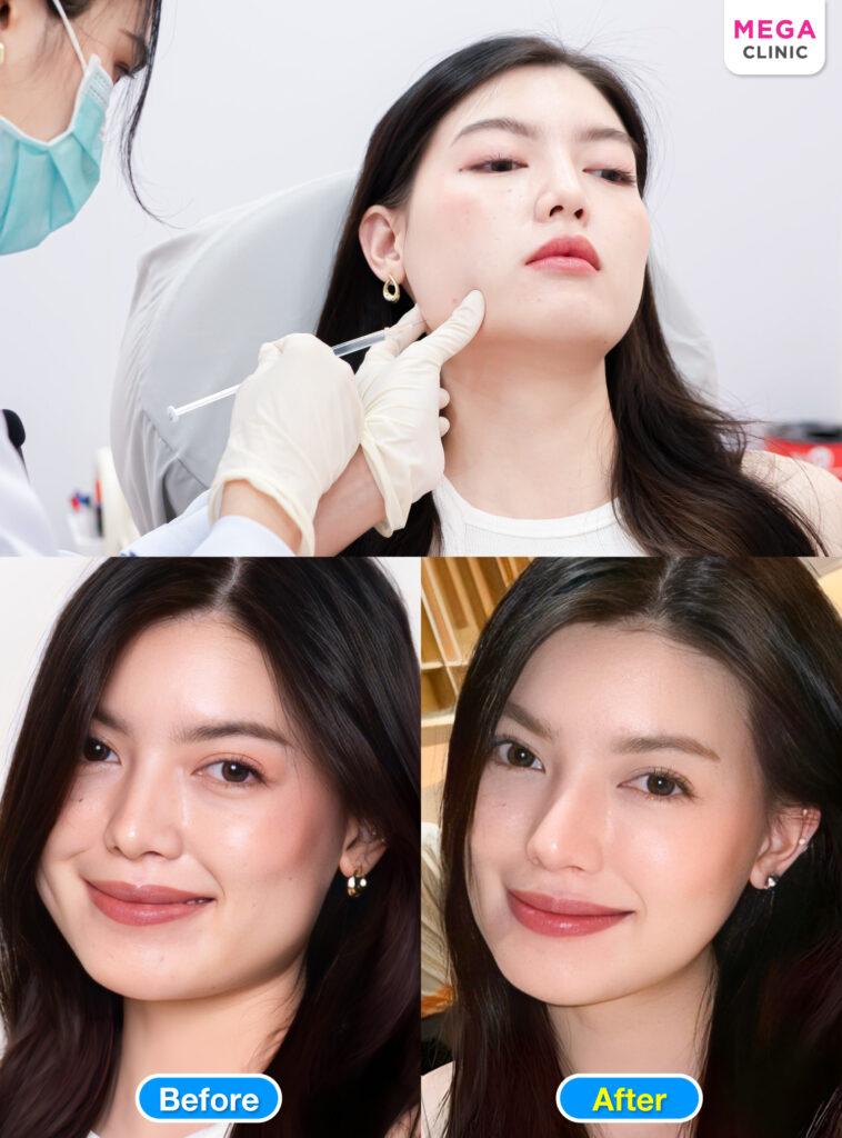 ฉีดโบท็อก กี่วันเห็นผล? คำตอบชัดที่นี่ | MEGA CLINIC