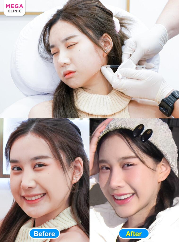 ฉีดโบท็อก กี่วันเห็นผล? คำตอบชัดที่นี่ | MEGA CLINIC