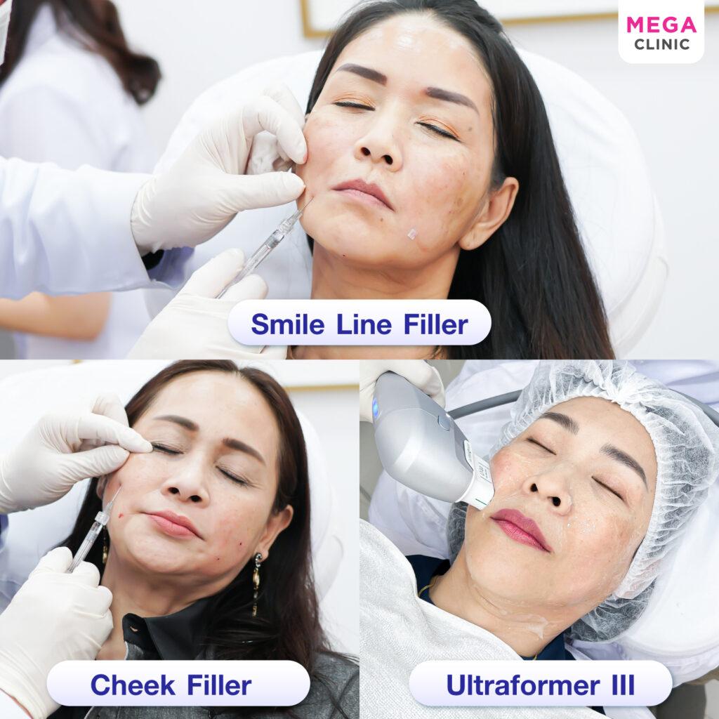 ฟิลเลอร์ร่องแก้ม เติมร่องลึกให้หน้าดูอ่อนเยาว์ | MEGA CLINIC