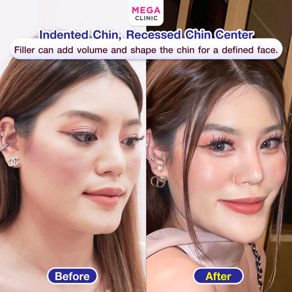 ฉีดฟิลเลอร์ แก้หน้าโทรมแค่ไหน? มาดู 5 สิ่งที่เปลี่ยนไป | MEGA CLINIC