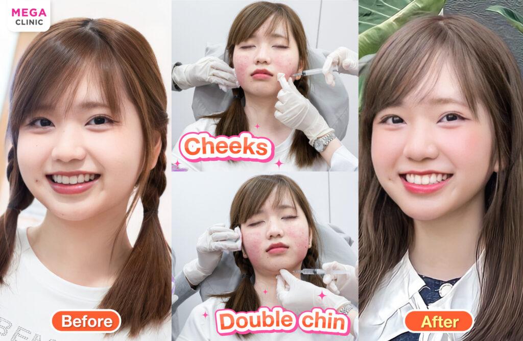 Round Face Problems: Causes and Clear Solutions for a Slimmer Look