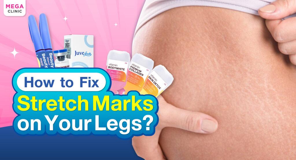 Stretch Marks on Your Legs? Here's How to Make Them Fade