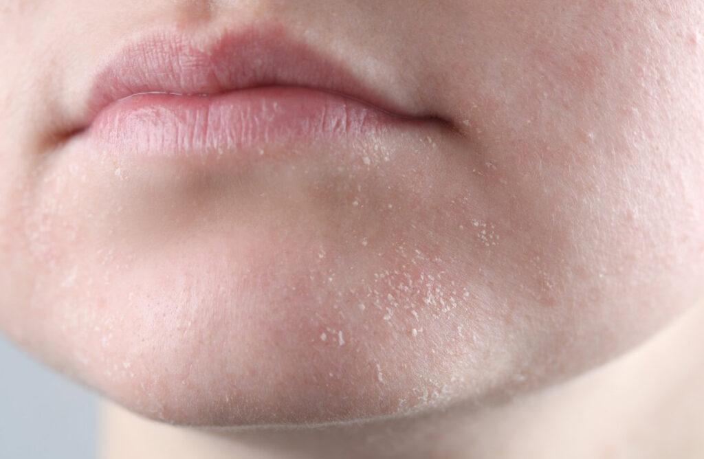 หน้าลอกเป็นขุยใช้อะไรดี รวมวิธีแก้ ด้วยหัตถการงานผิว เติมความชุ่มชื้น