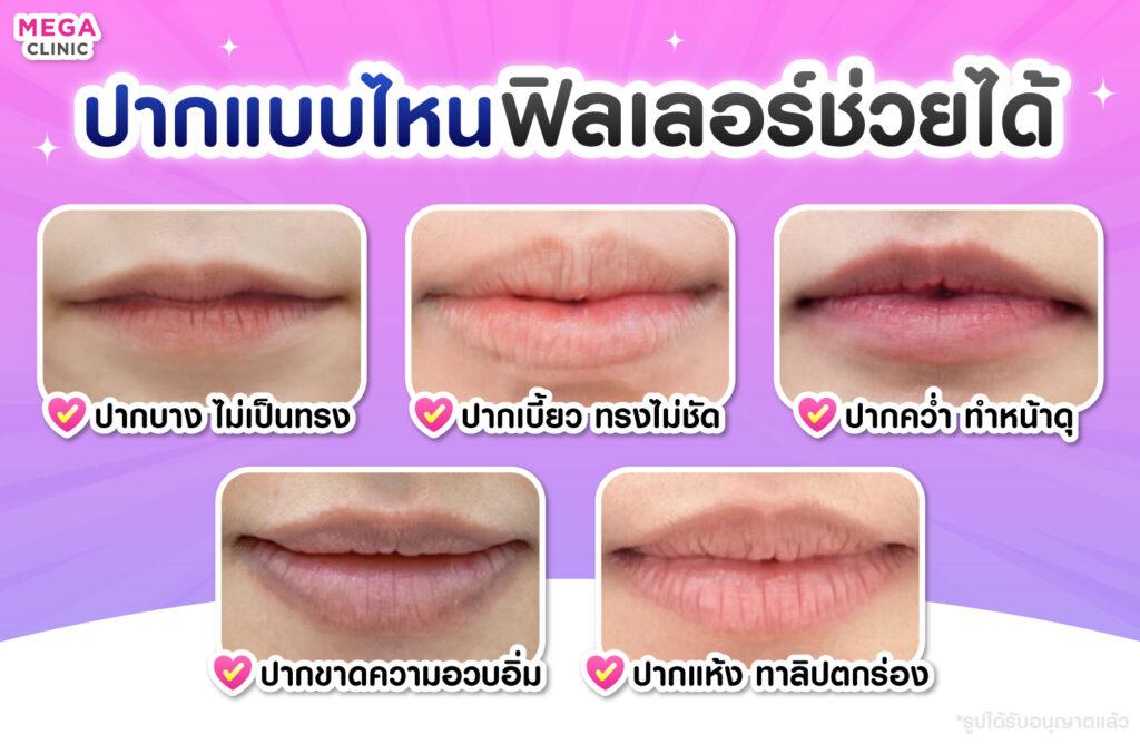 How to Fix Thin Lips: Create a Beautiful Shape with Lip Filler