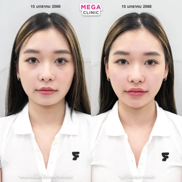 Real Patient Reviews – Chin Filler in Bangkok | MEGA CLINIC Thailand