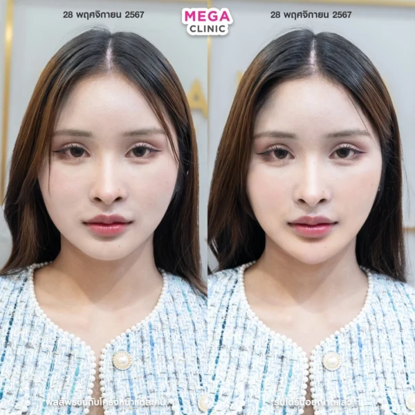 Real Patient Reviews – Chin Filler in Bangkok | MEGA CLINIC Thailand