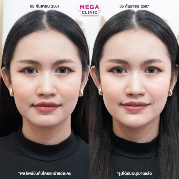 Real Patient Reviews – Chin Filler in Bangkok | MEGA CLINIC Thailand