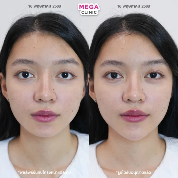 Real Patient Reviews – Chin Filler in Bangkok | MEGA CLINIC Thailand