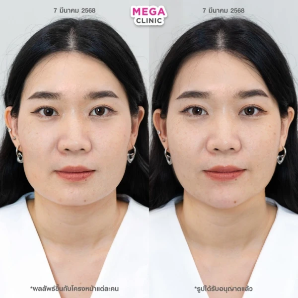 Real Patient Reviews – Chin Filler in Bangkok | MEGA CLINIC Thailand