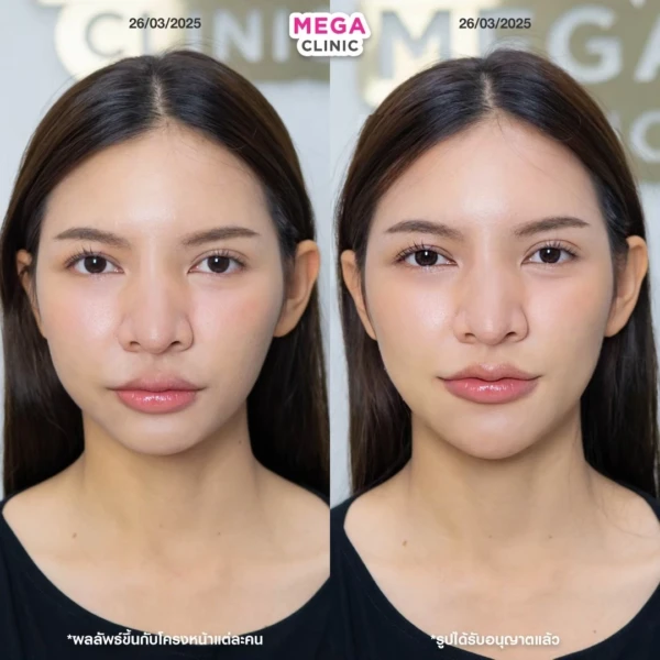 Real Patient Reviews – Chin Filler in Bangkok | MEGA CLINIC Thailand