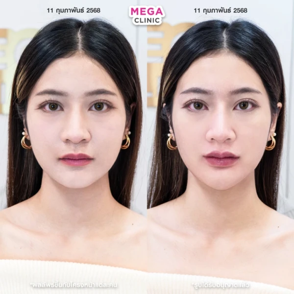 Real Patient Reviews – Chin Filler in Bangkok | MEGA CLINIC Thailand