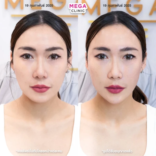 Real Patient Reviews – Chin Filler in Bangkok | MEGA CLINIC Thailand