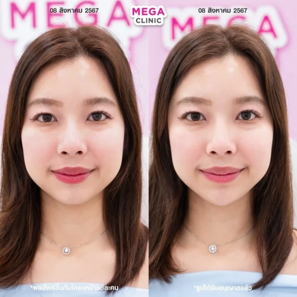 Real Patient Reviews – Chin Filler in Bangkok | MEGA CLINIC Thailand