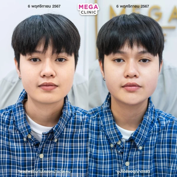 Real Patient Reviews – Chin Filler in Bangkok | MEGA CLINIC Thailand